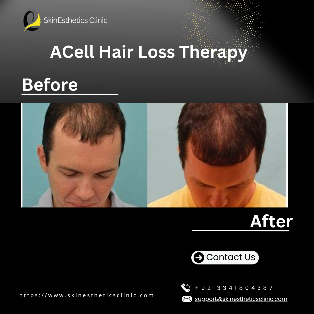 ACell Hair Loss Therapy - Skin Esthetics Clinic